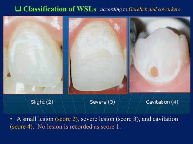 White spot lesions | PDF