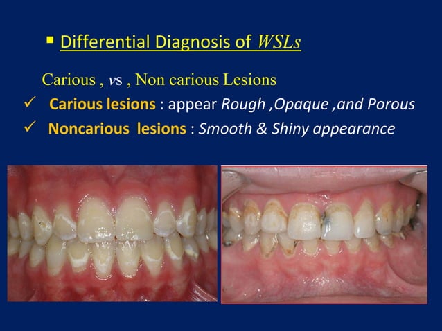 White spot lesions | PDF