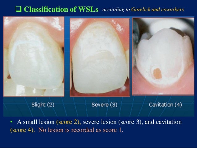 White spot lesions