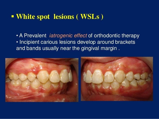 White spot lesions