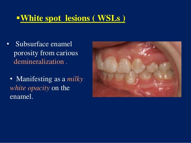 White spot lesions