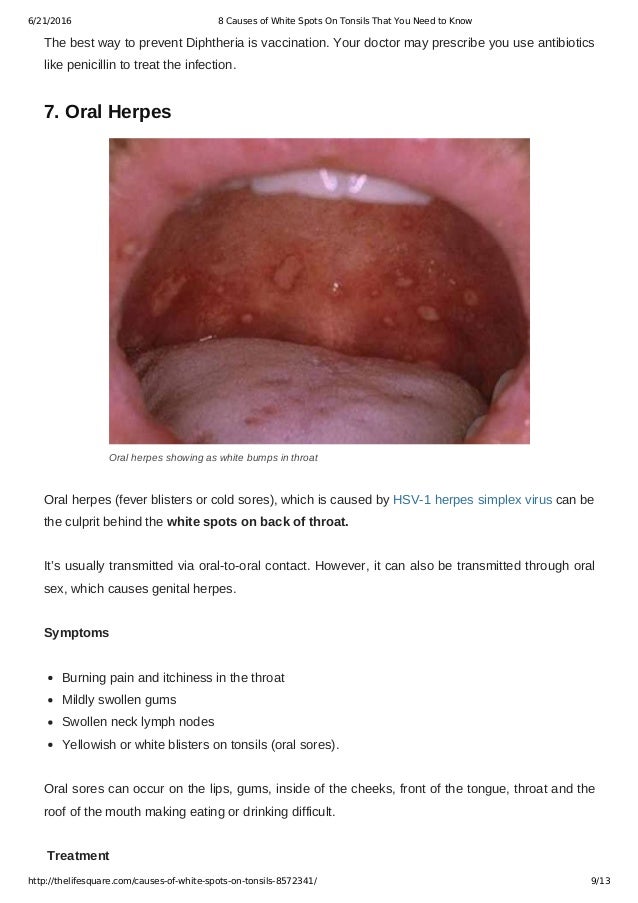 8 Causes of White Spots On Tonsils That You Need to Know