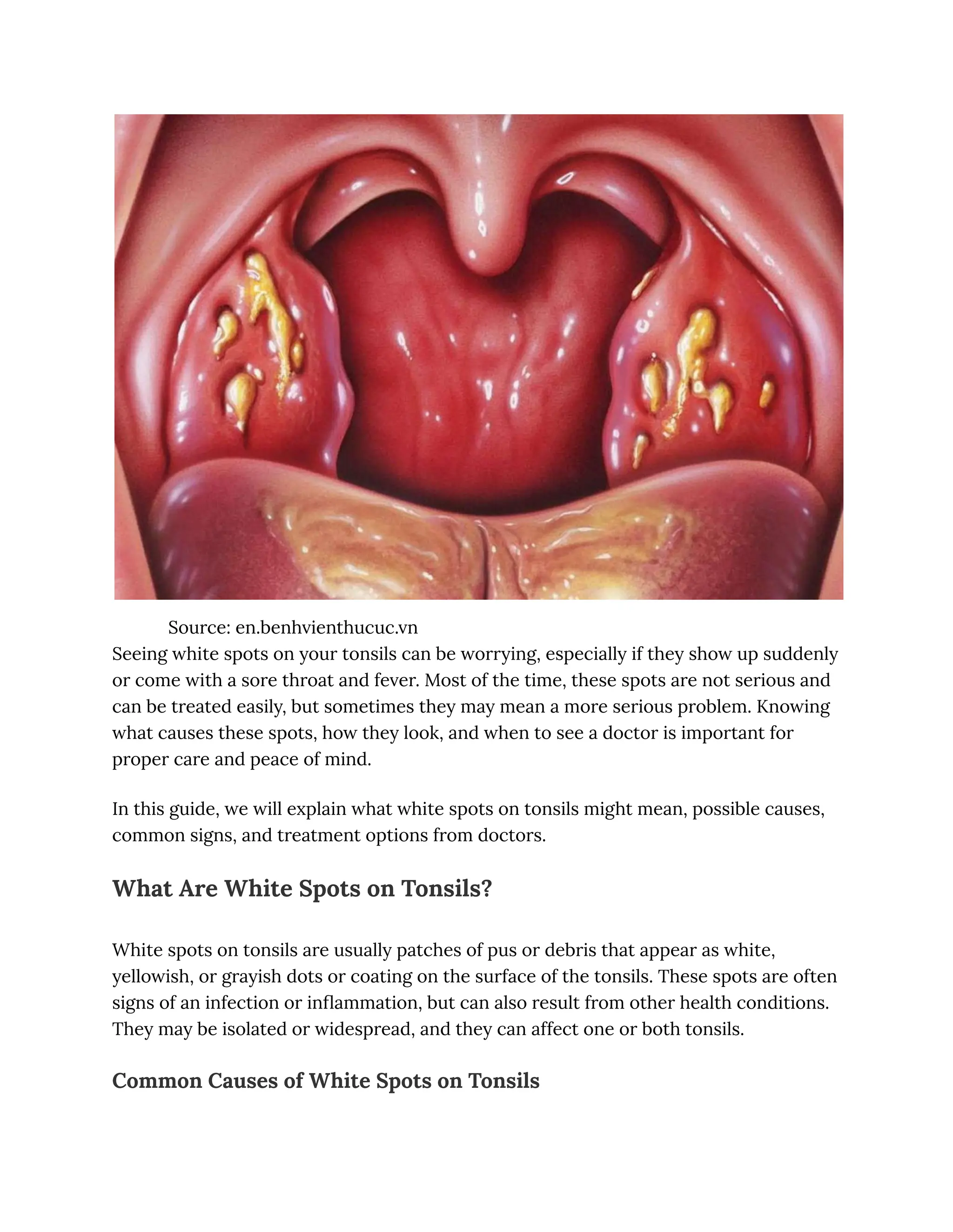 White Spots on Tonsils Causes & When to See a Doctor The Lifesciences ...