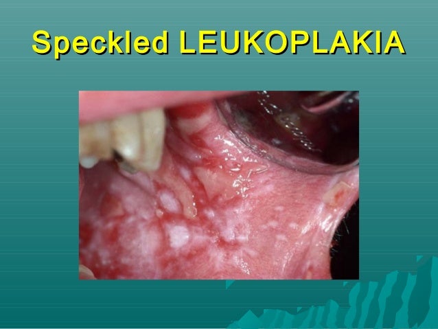 Whit lesions