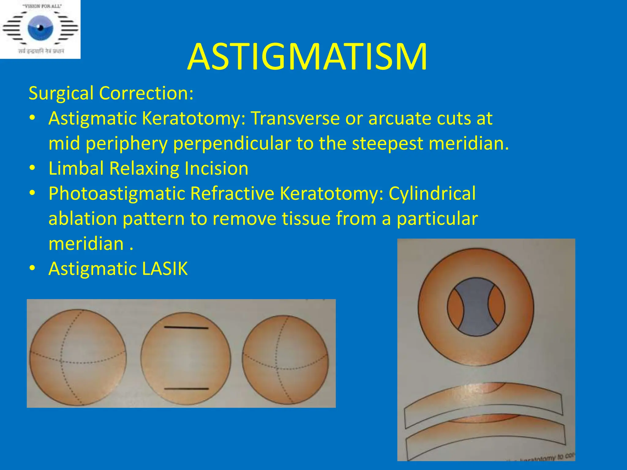 ASTIGAMATISM presentation dhir hospital.pptx