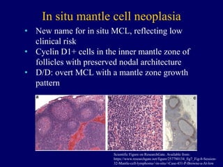 Who 2016 updated classification of lymphoid neoplasm | PDF
