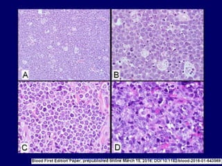 Who 2016 updated classification of lymphoid neoplasm | PDF