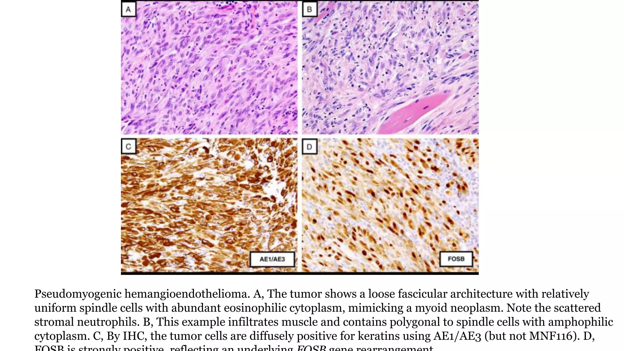 WHO Bone and soft tissue tumor UPDATE 2020 | PPTX
