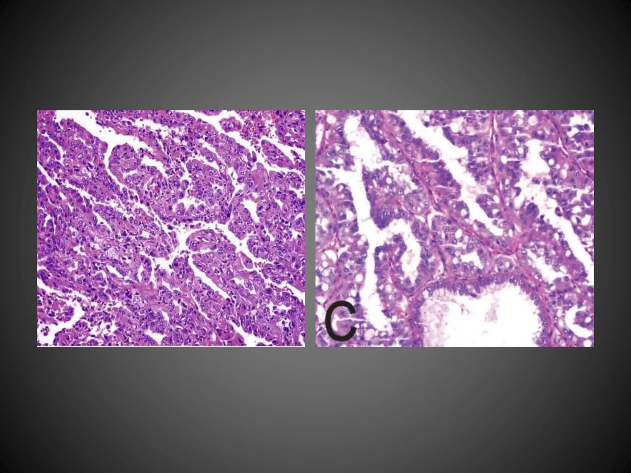 WHO CLASSIFICATION 2016 RENAL CELL CARCINOMA.pptx