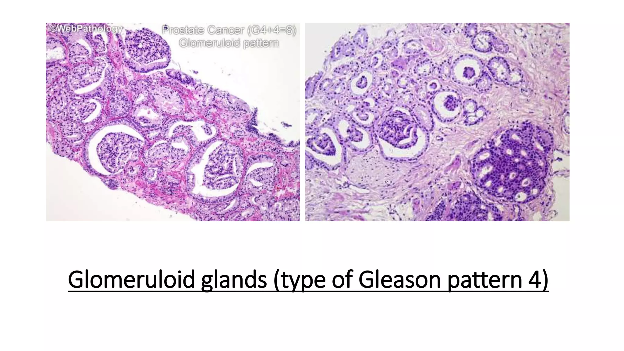 WHO Classification of Tumors fifth edition.pptx