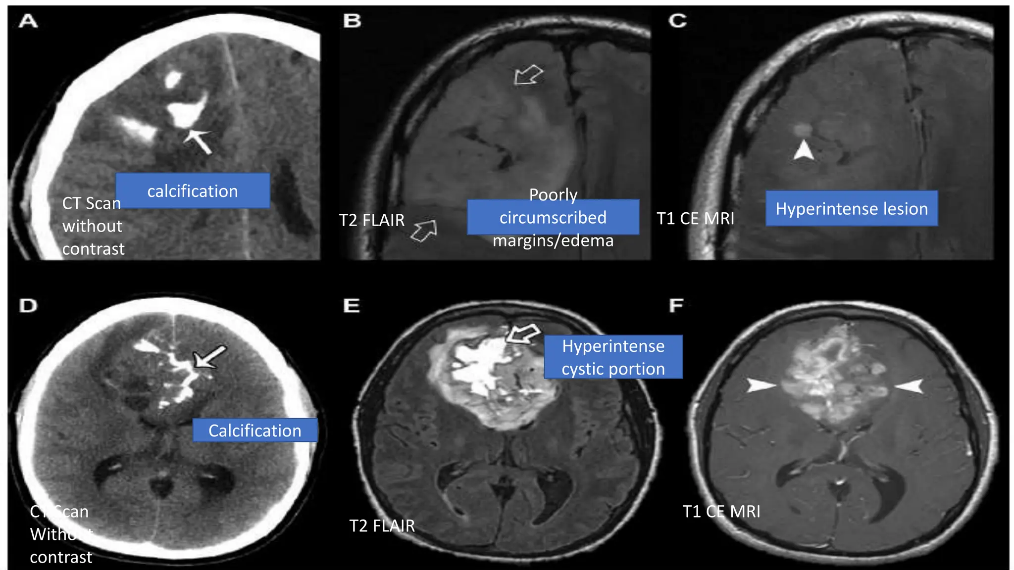 WHO CNS Classification of Tumors 2021-2.pptx
