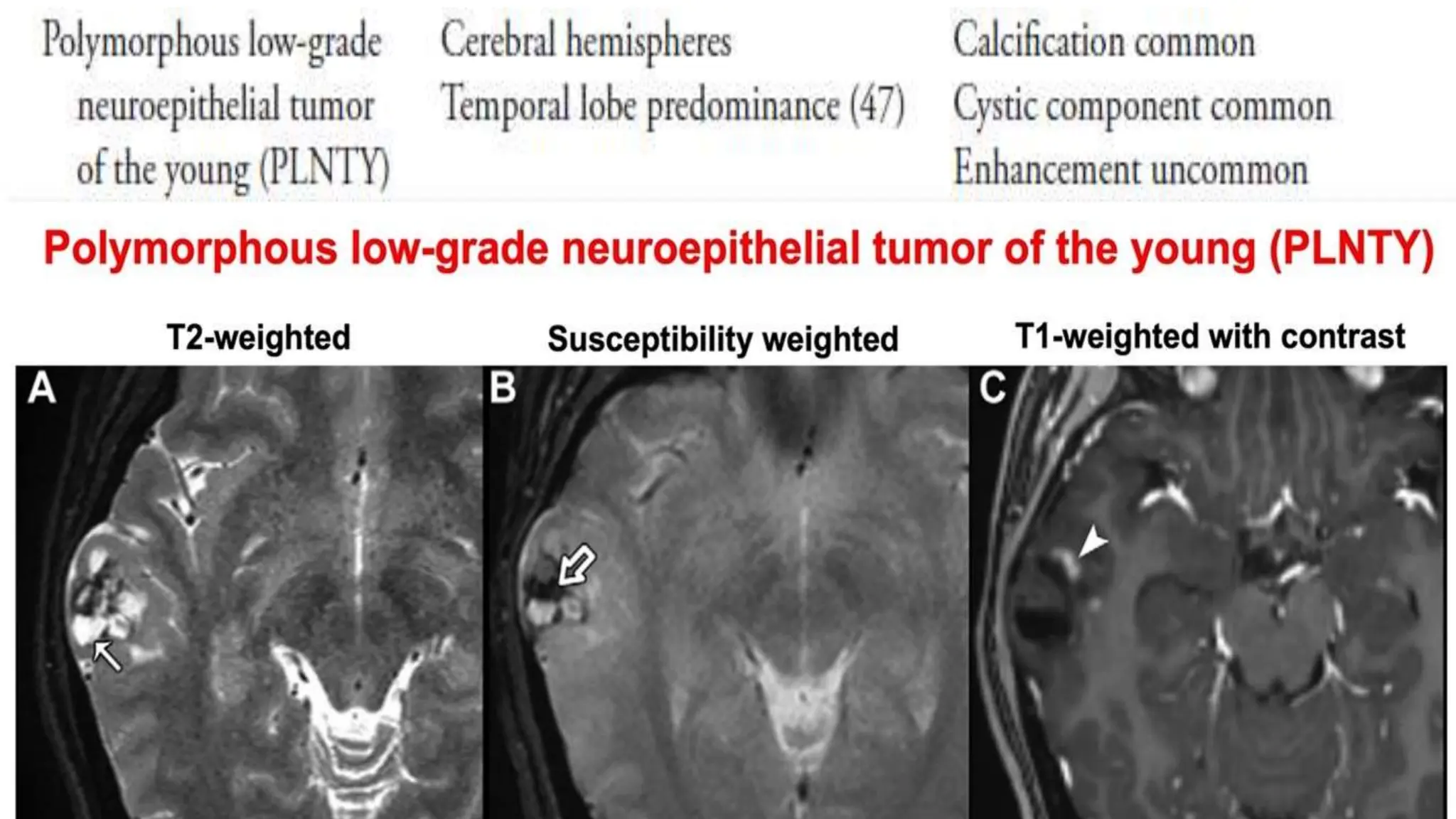 WHO CNS Classification of Tumors 2021-2.pptx