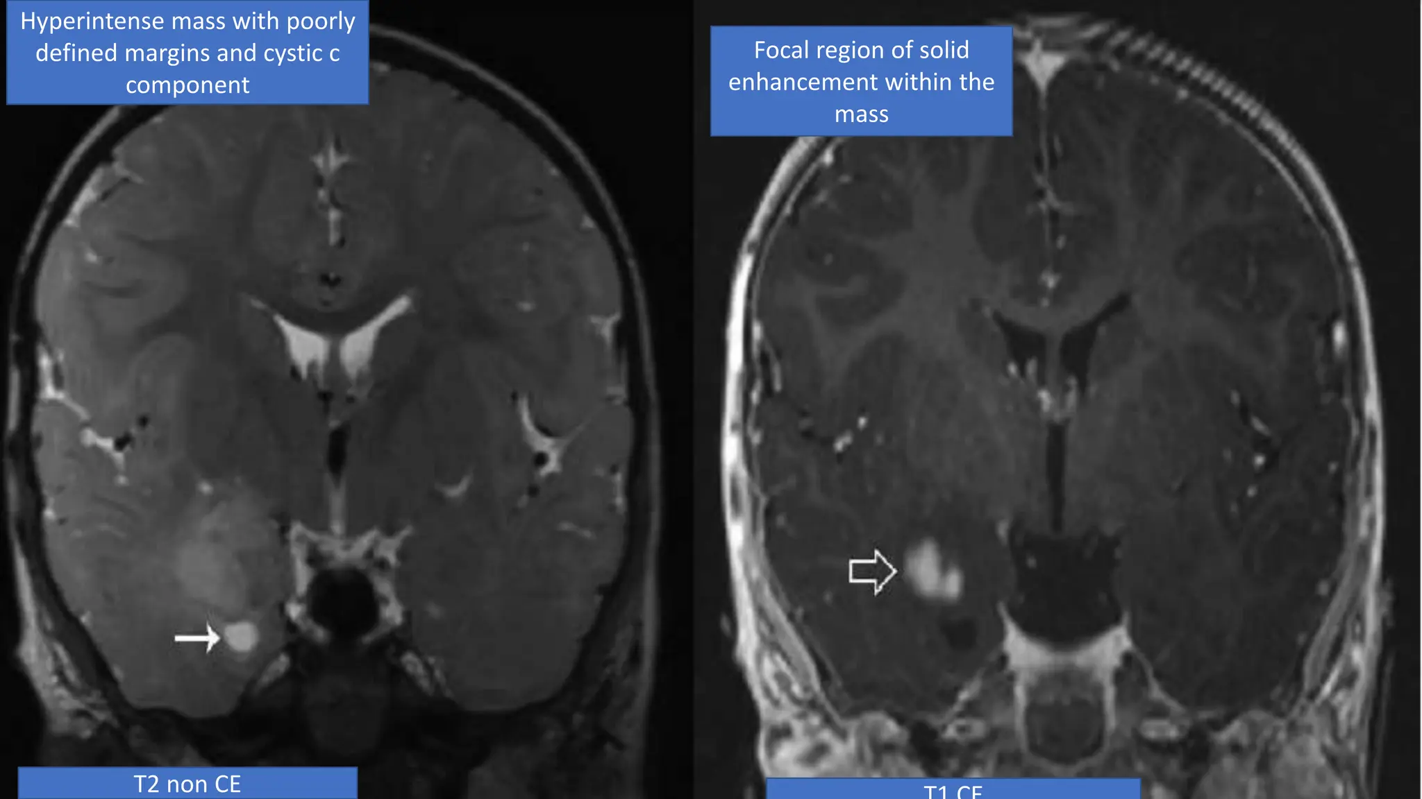 WHO CNS Classification of Tumors 2021-2.pptx