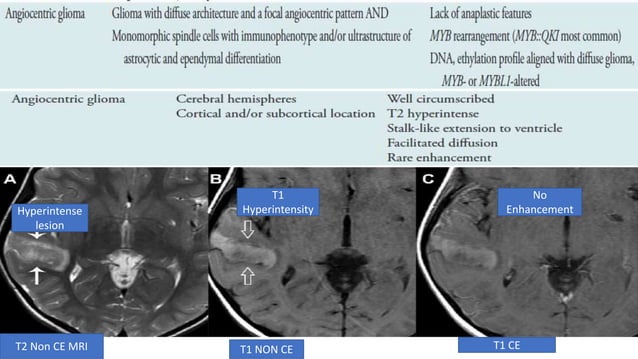 WHO CNS Classification of Tumors 2021-2.pptx | Cancer | Diseases and ...