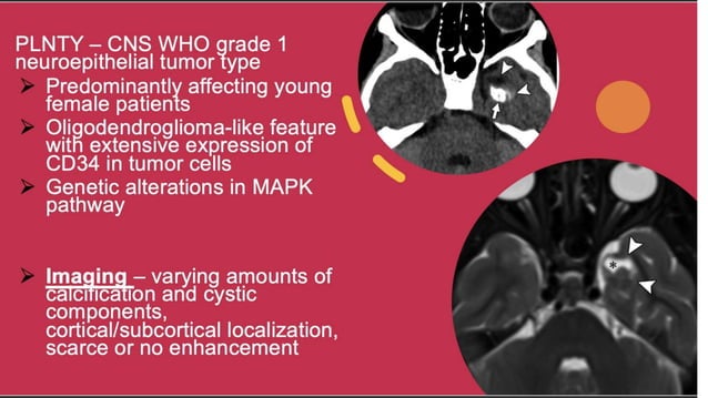 WHO CNS Classification of Tumors 2021-2.pptx | Cancer | Diseases and ...