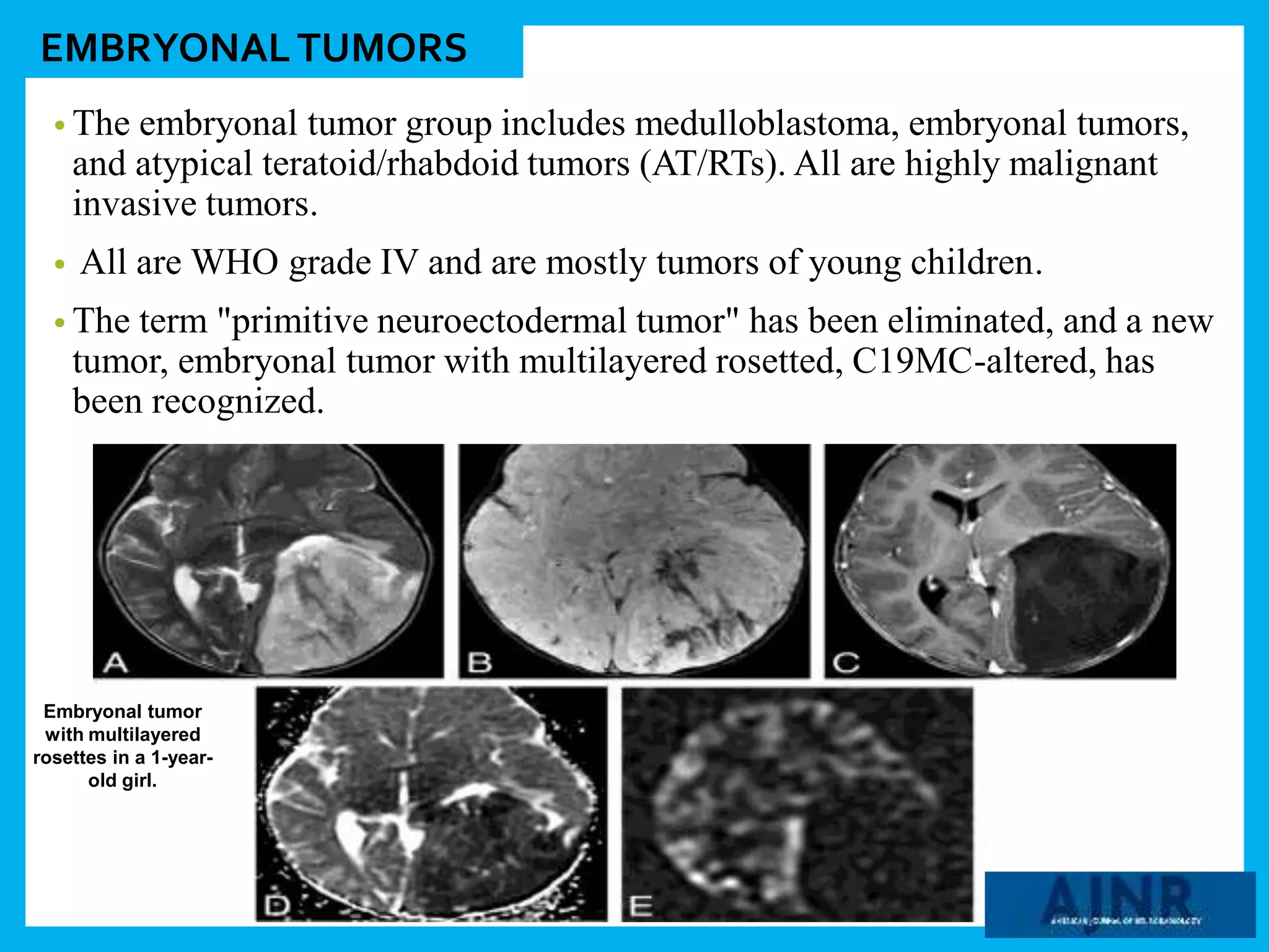 WHO CNS Tumor Classification 2021.pptx | Brain and Nervous System Disorders | Diseases and ...
