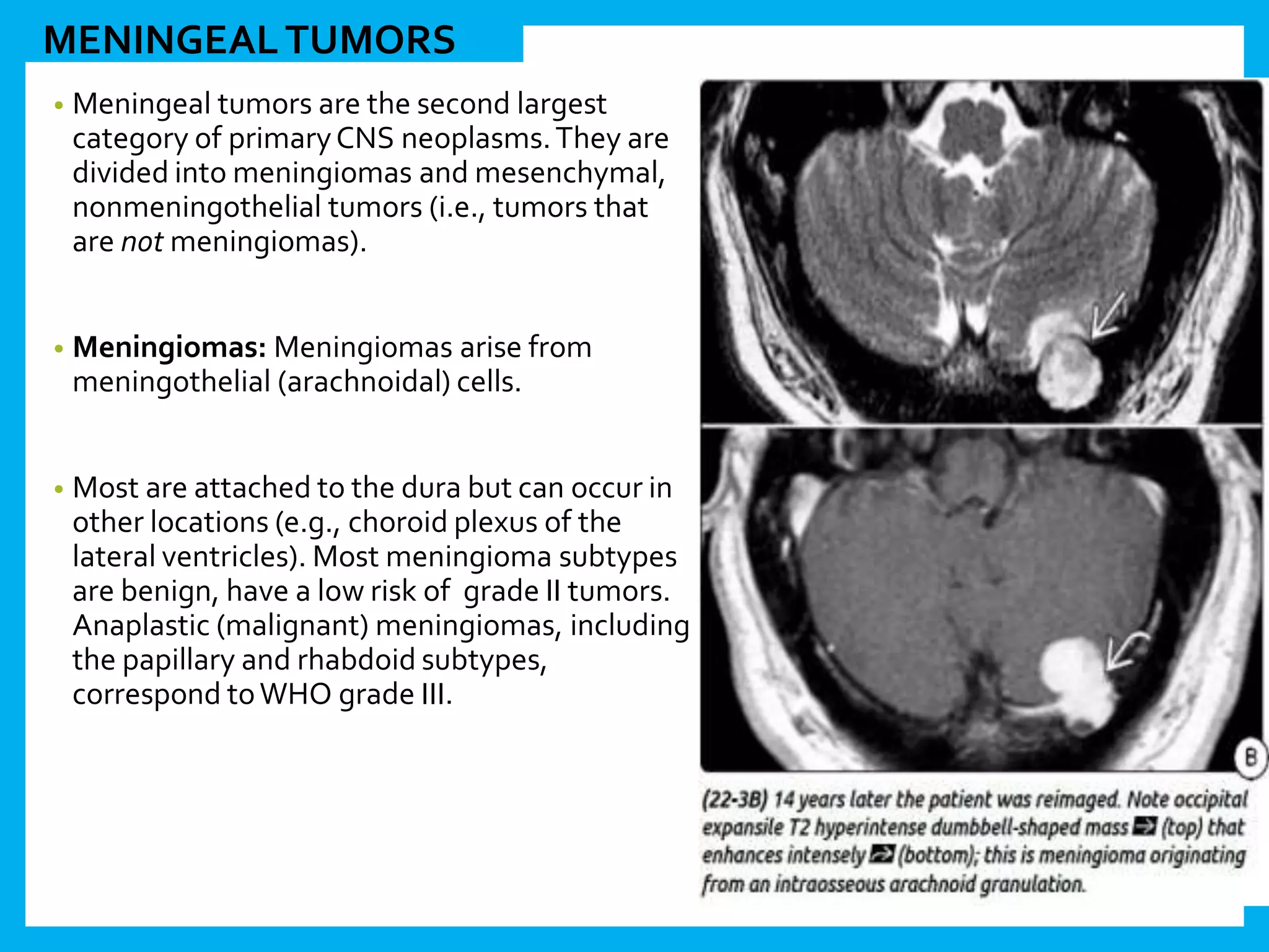WHO CNS Tumor Classification 2021.pptx | Brain and Nervous System Disorders | Diseases and ...