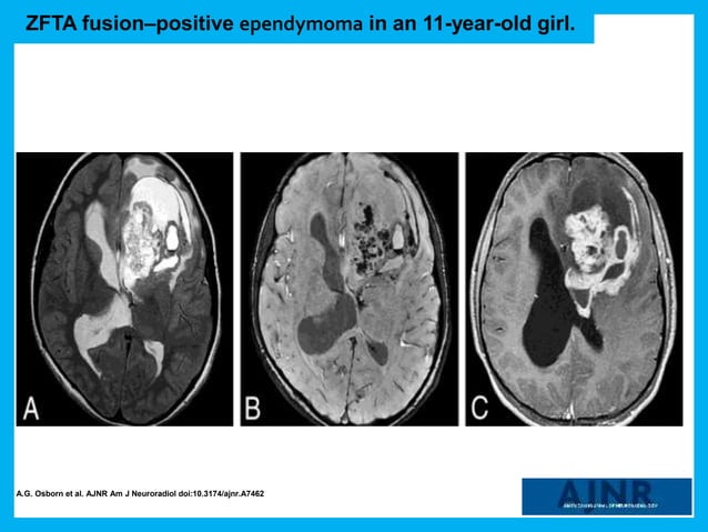 WHO CNS Tumor Classification 2021.pptx | Brain and Nervous System ...