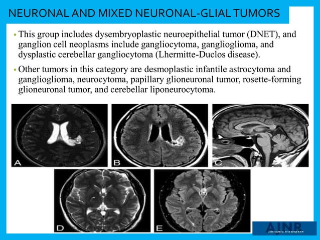 WHO CNS Tumor Classification 2021.pptx | Brain and Nervous System ...