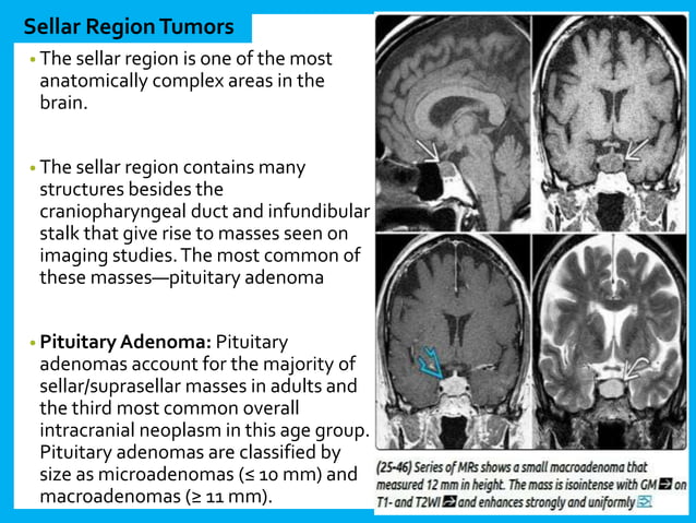WHO CNS Tumor Classification 2021.pptx | Brain and Nervous System ...