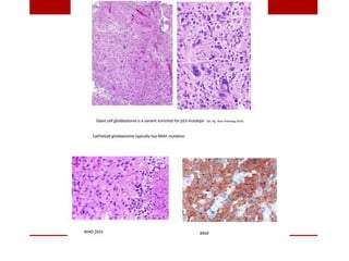 who criteria gbm.ppt