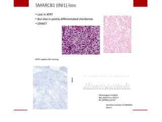 who criteria gbm.ppt