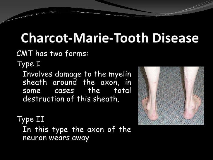 Whole genome sequencing in a patient with charcot-marie-tooth neuropa…
