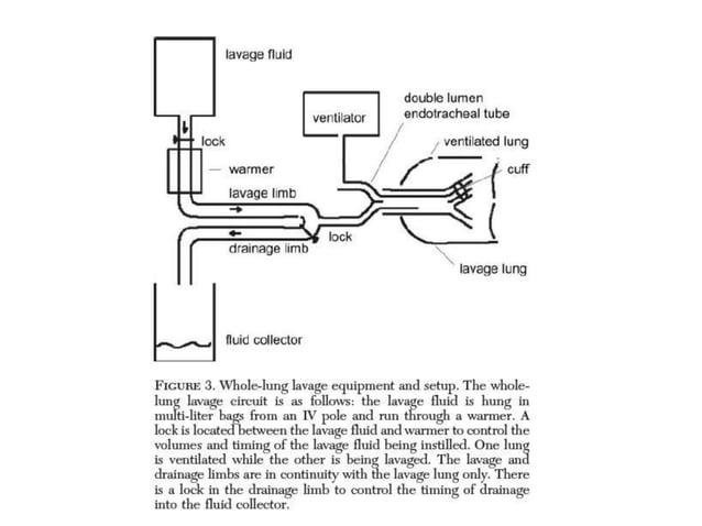 Whole Lung Lavage for Pulmonary Alveolar Proteinosis | PPTX | Lung and ...