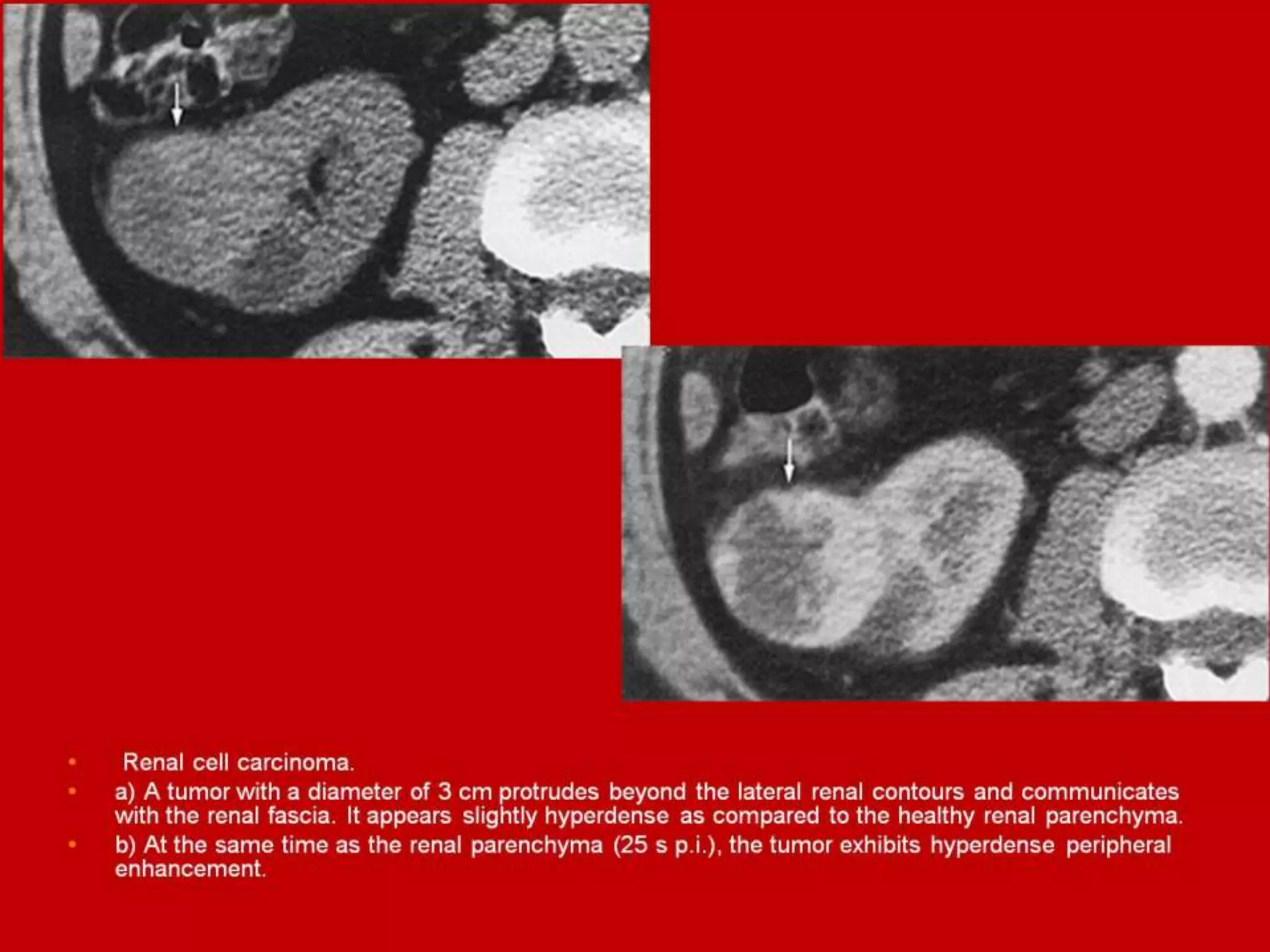 Whole body computed tomography kidney | PPTX