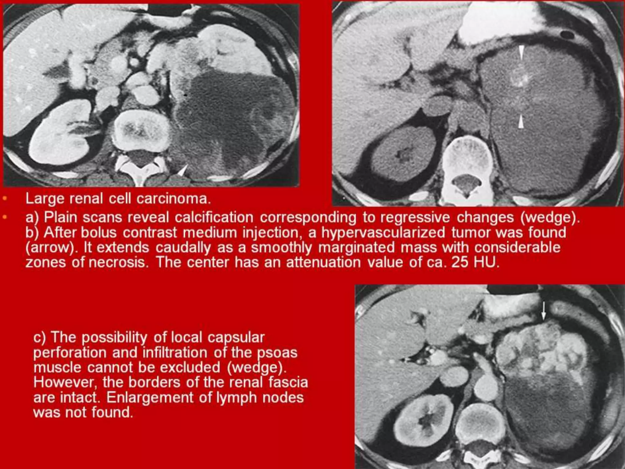 Whole body computed tomography kidney | PPTX
