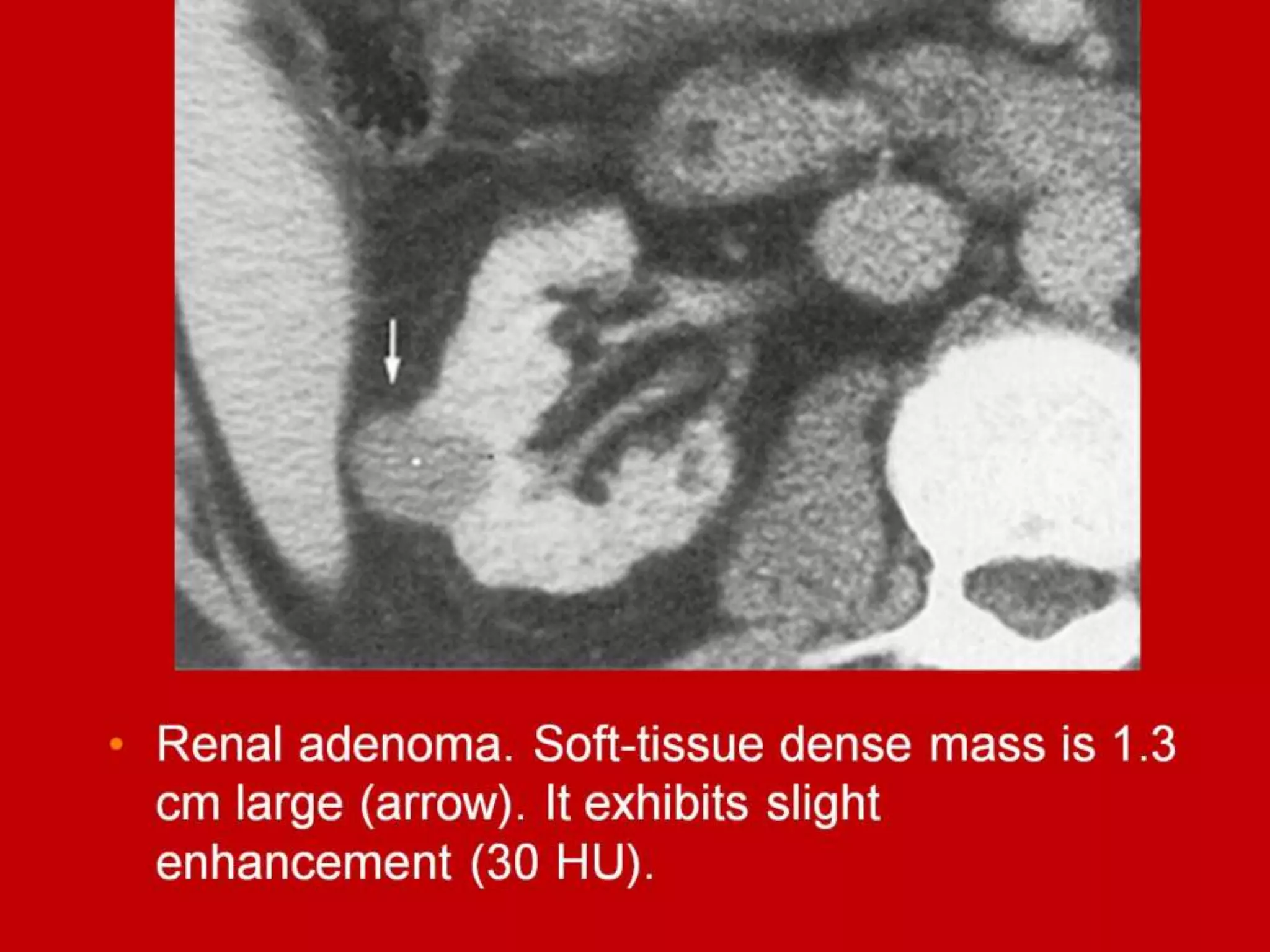 Whole body computed tomography kidney | PPTX