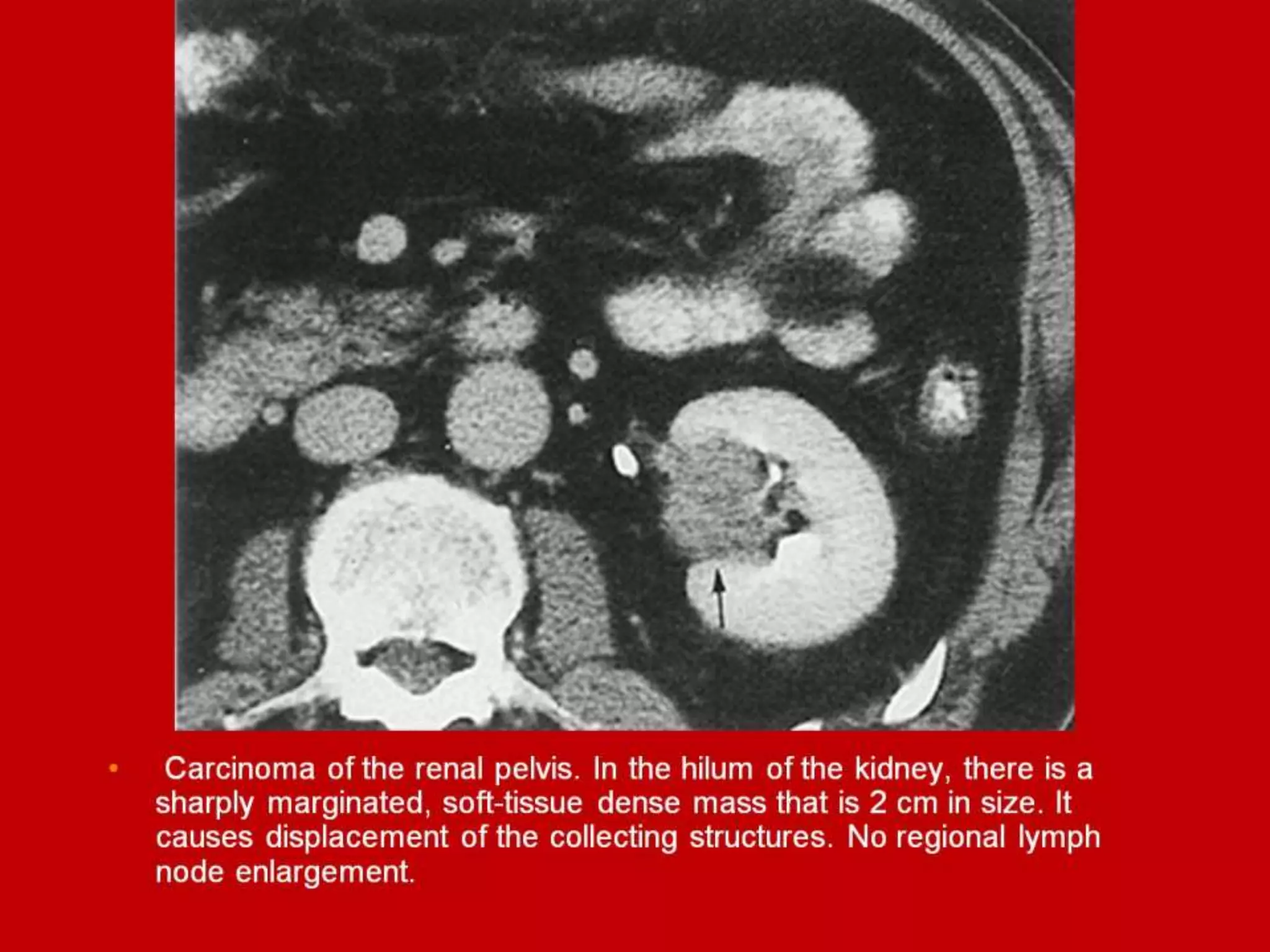 Whole body computed tomography kidney | PPTX