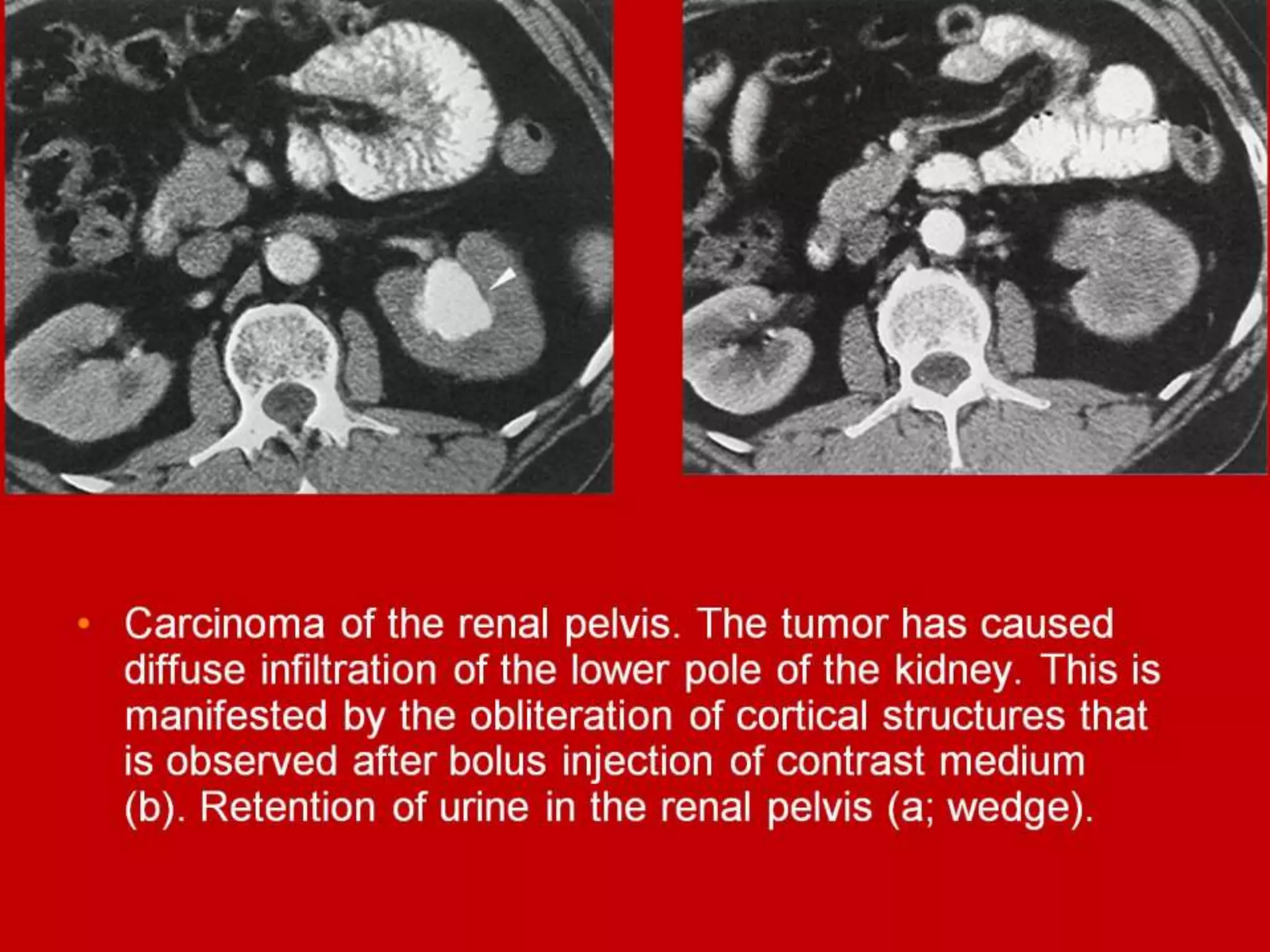 Whole body computed tomography kidney | PPTX