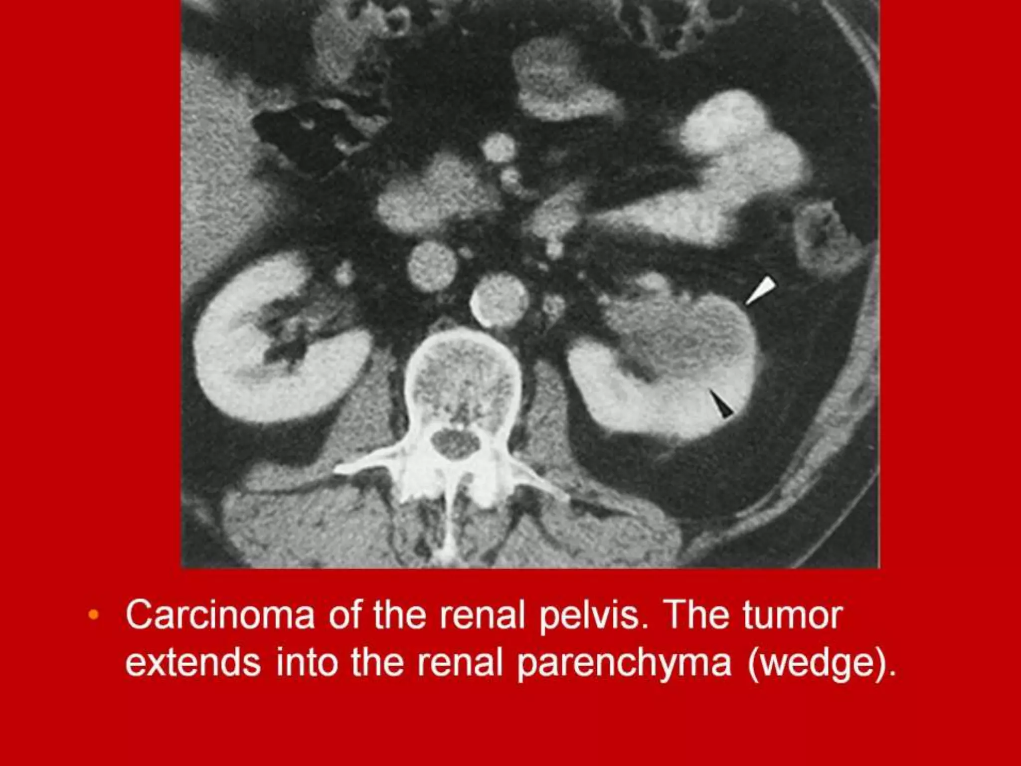 Whole body computed tomography kidney | PPTX