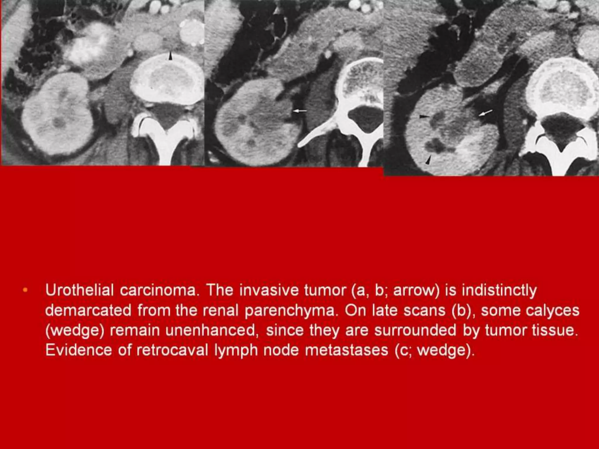 Whole body computed tomography kidney | PPTX