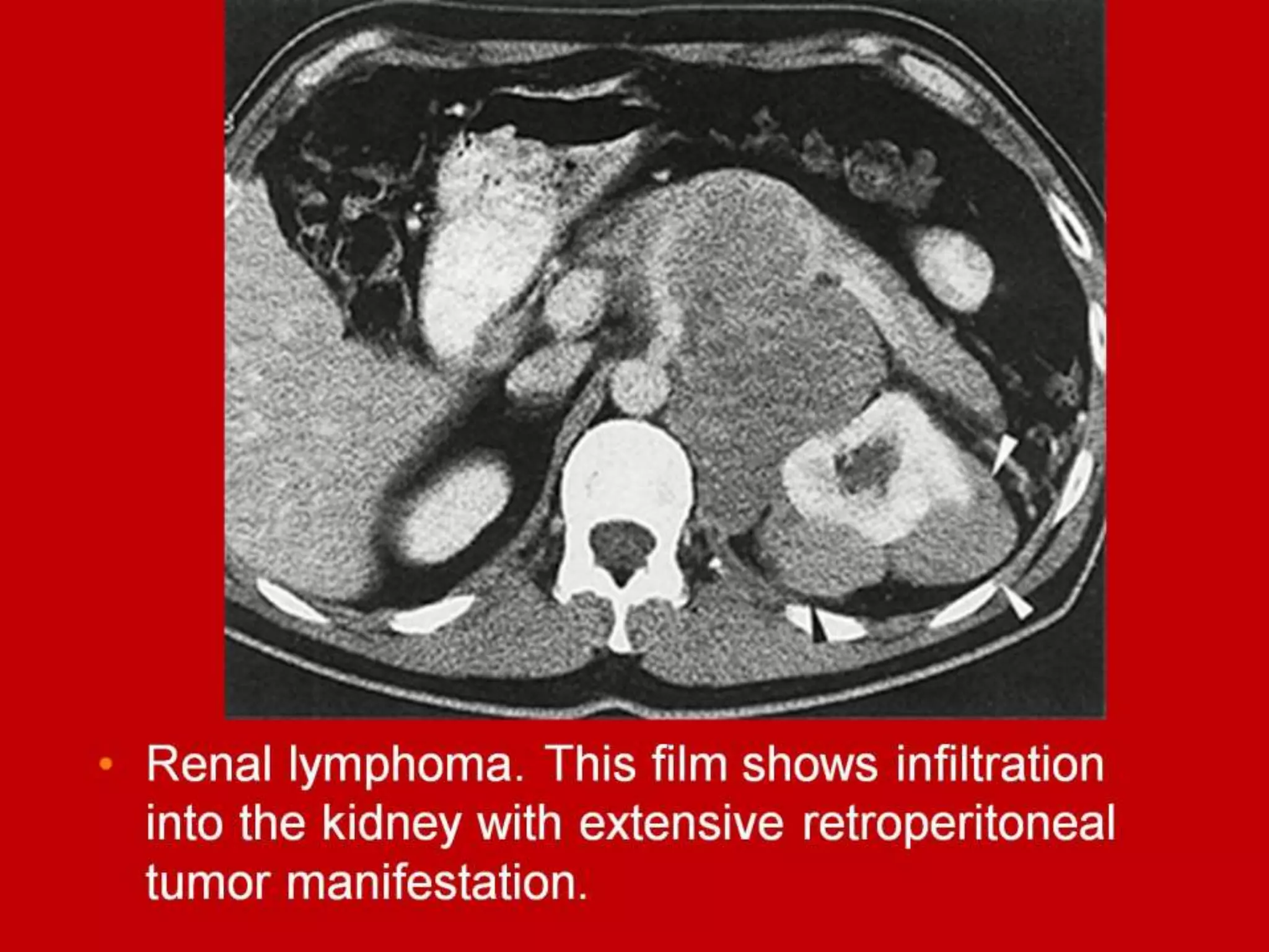 Whole body computed tomography kidney | PPTX