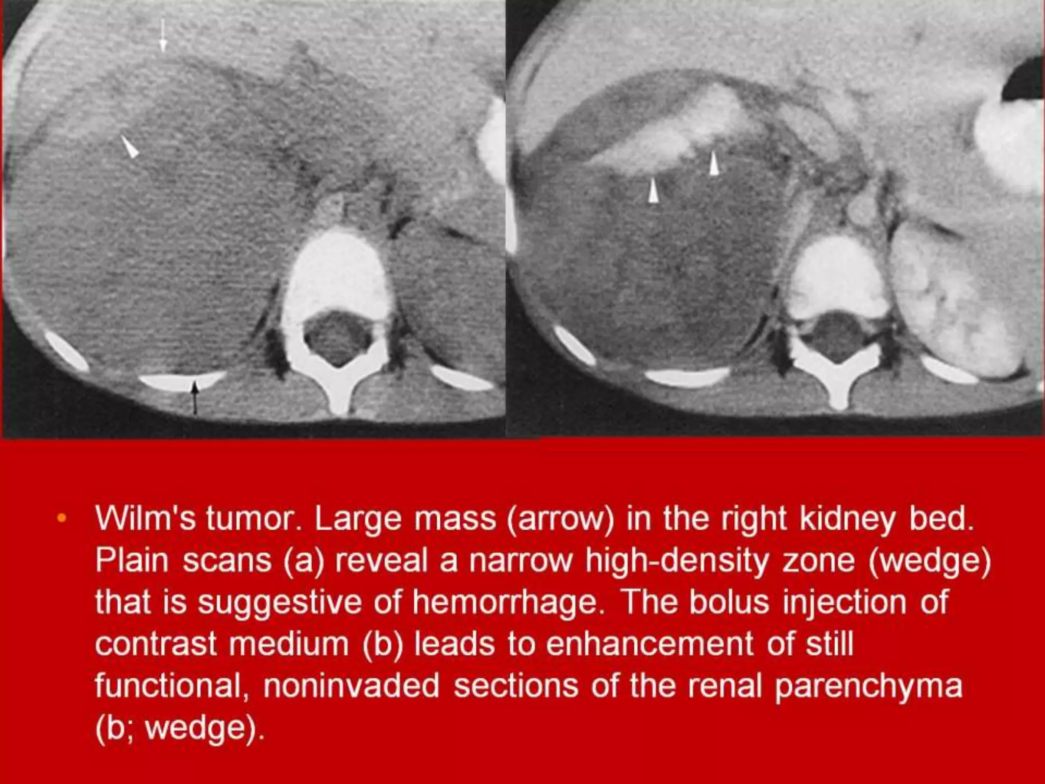 Whole body computed tomography kidney | PPTX