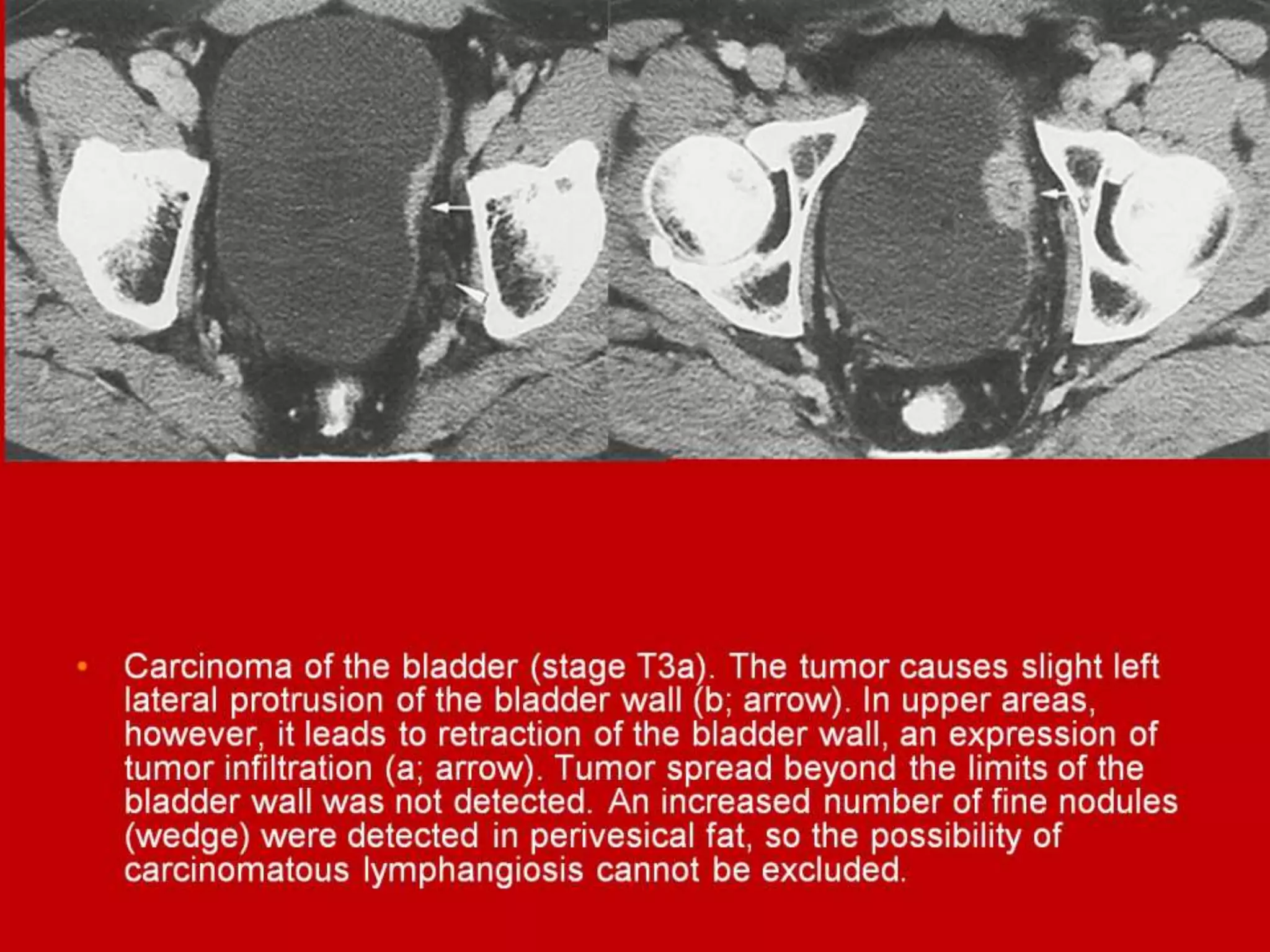 Whole body computed tomography urinary bladder | PPT