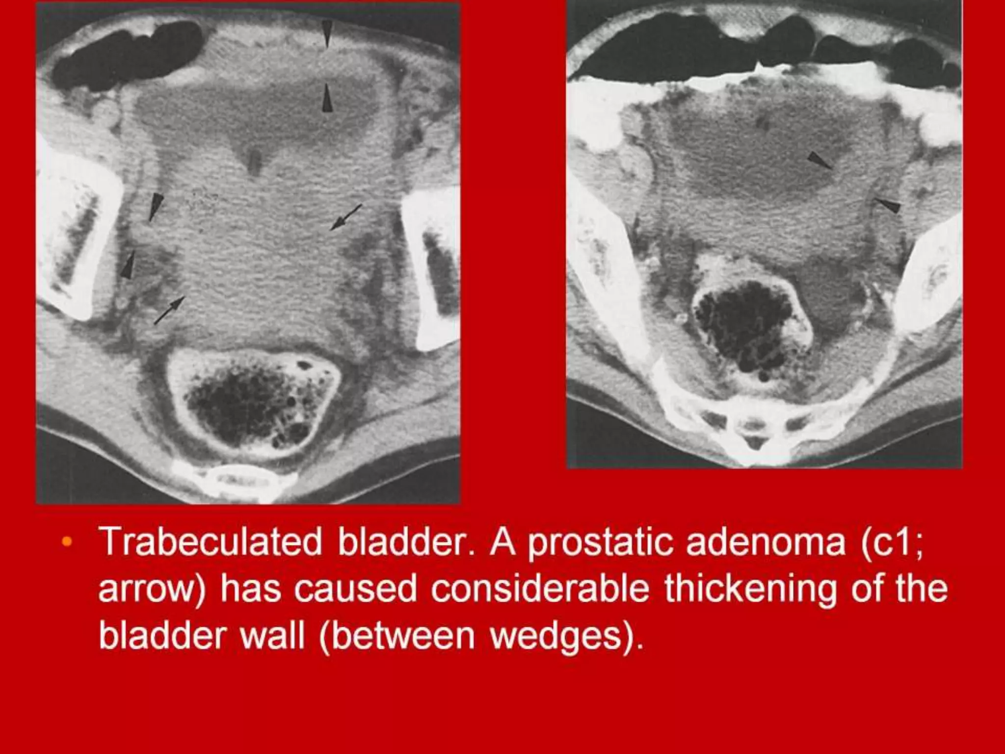 Whole body computed tomography urinary bladder | PPT