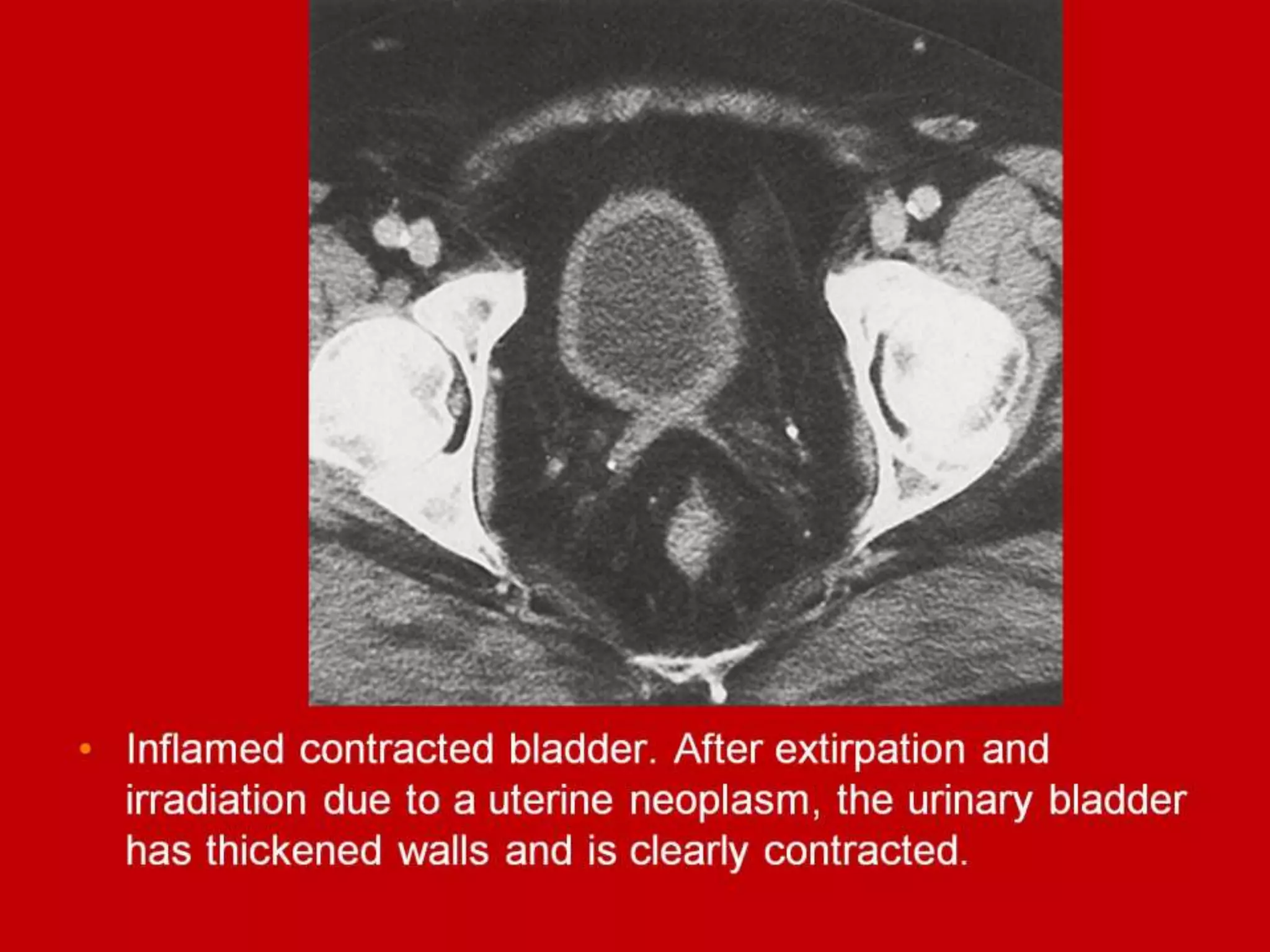 Whole body computed tomography urinary bladder | PPT