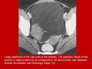 Whole body computed tomography urinary bladder | PPT