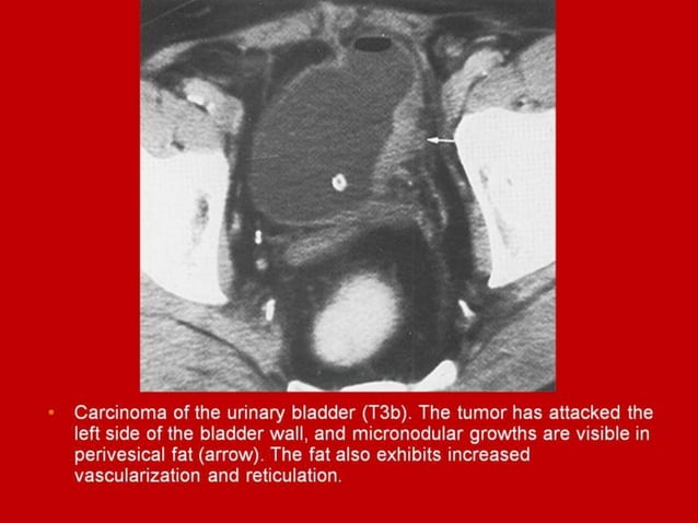 Whole body computed tomography urinary bladder | PPT