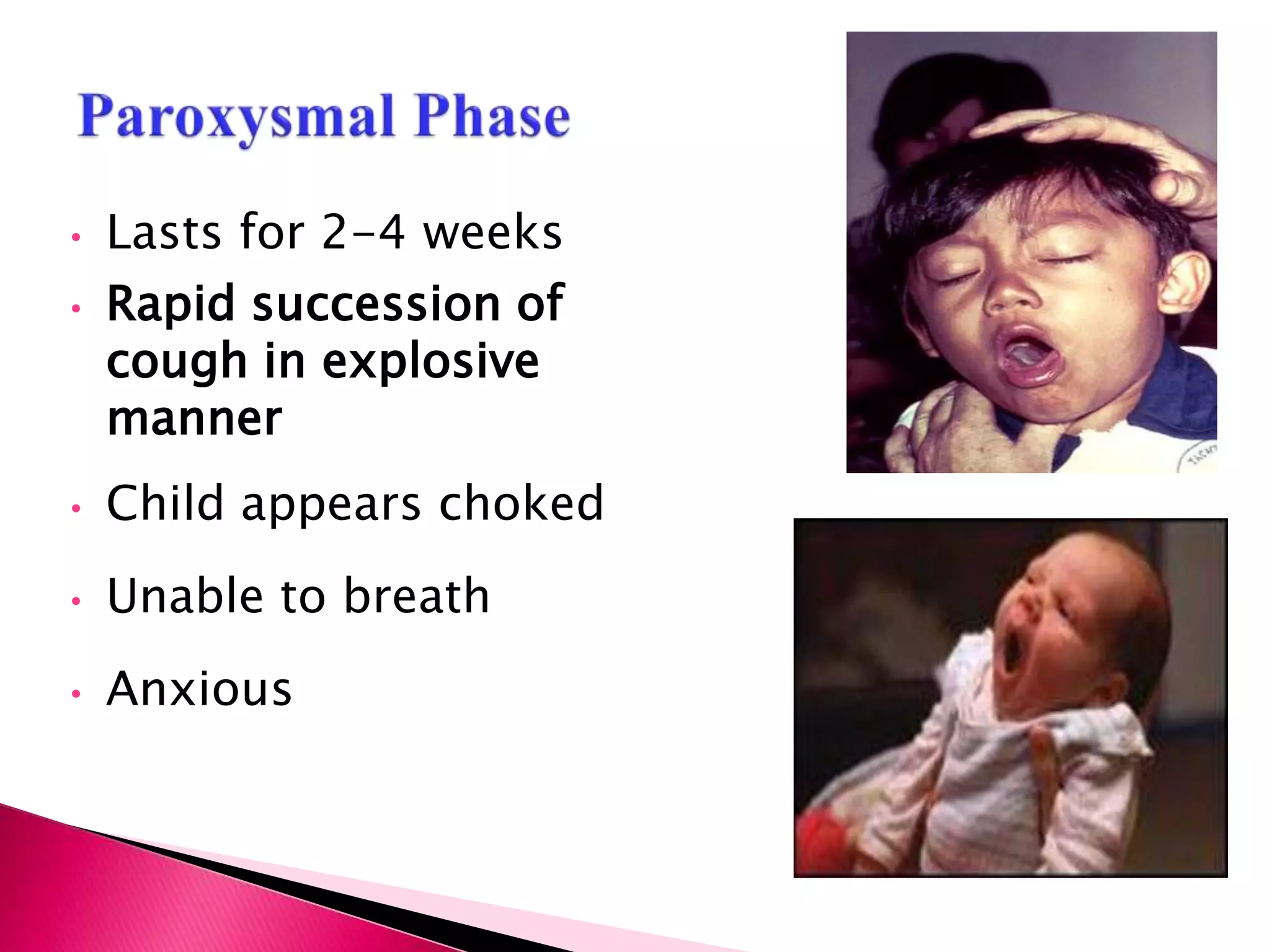 Whooping cough | PPTX