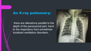 Whooping cough | pertussis ( medical information ) - a detailed study | PPT