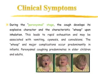 whooping cough.ppt