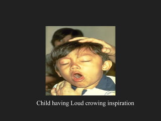 Whooping Cough infectious diseases presentation | PPTX