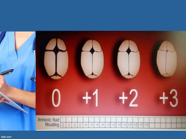 WHO partograph | PPT