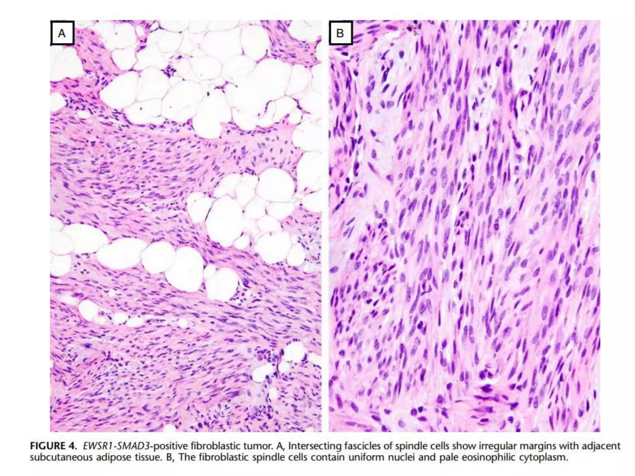 WHO updates on soft tissue tumors.pptx