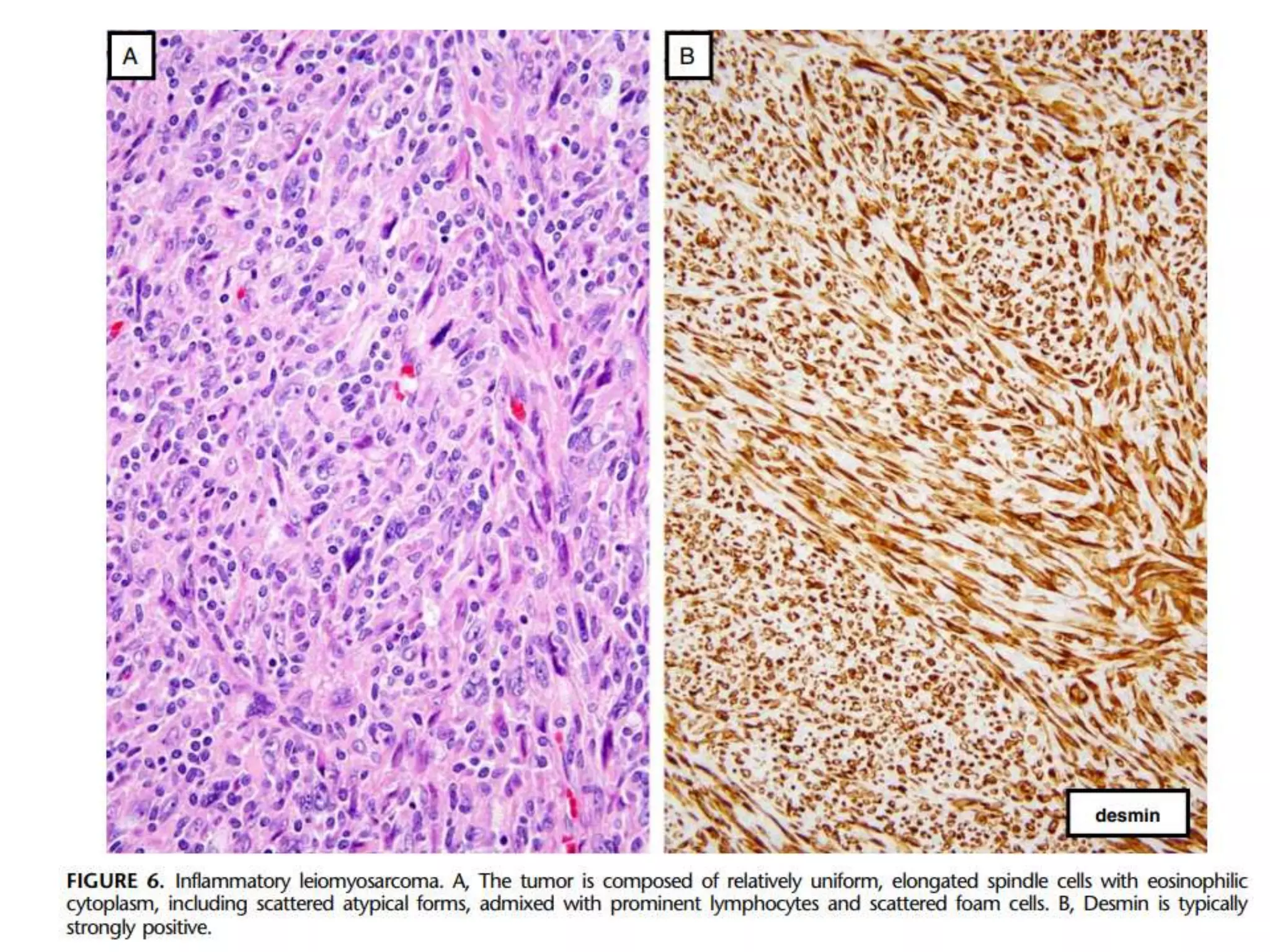 WHO updates on soft tissue tumors.pptx