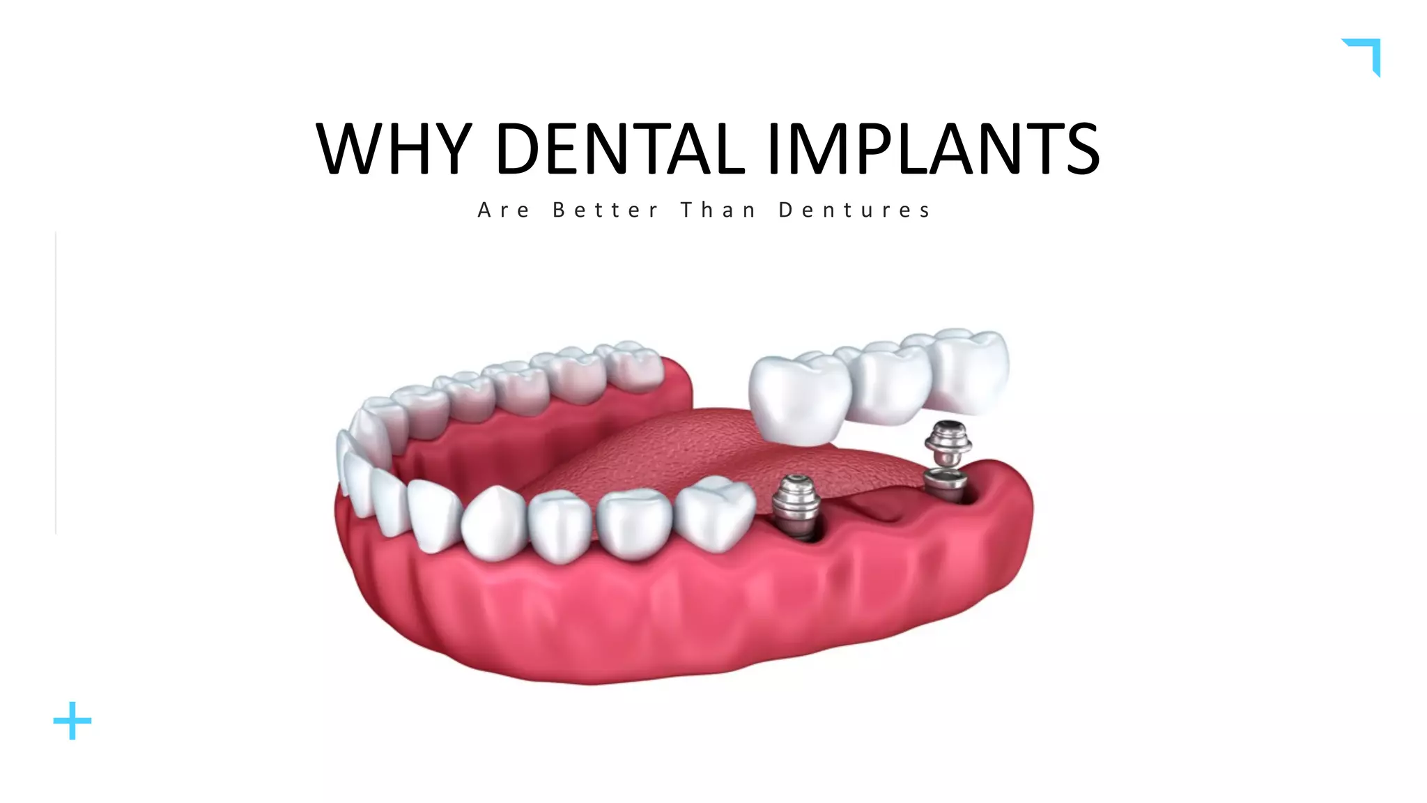 Why Dental Implants are Better Than Dentures | PPT